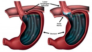 17 Proven GERD Risk Factors (And How To Stop Them)