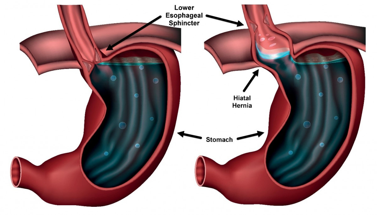 17 Proven GERD Risk Factors (And How To Stop Them)